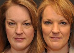 Blepharoplasty in Cincinnati | Dr. Alexander Donath