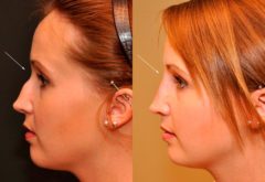 Injection Rhinoplasty Photos | Cincinnati, OH | Patient 5839
