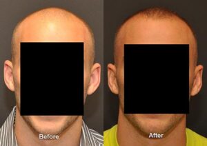 Otoplasty Recovery: What to Expect and How Long It Takes