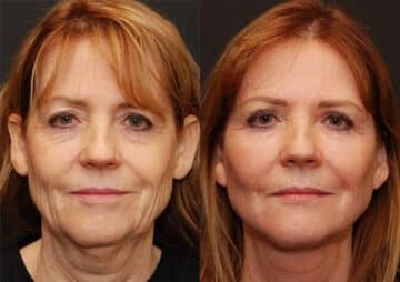 Mini Facelift Recovery Period: What to Expect