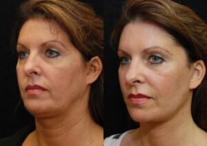 Mini Facelift Recovery Time: What to Expect