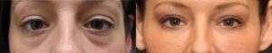 Before and After Photos - Cincinnati Facial Plastic Surgery