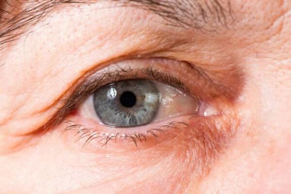How to Treat Under-Eye Wrinkles | Alexander Donath, MD