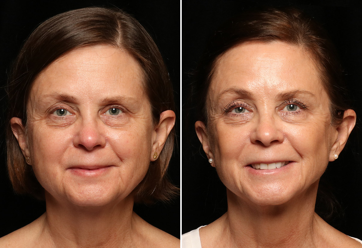 What is a Non-Surgical Facelift and What Can It Do for You?