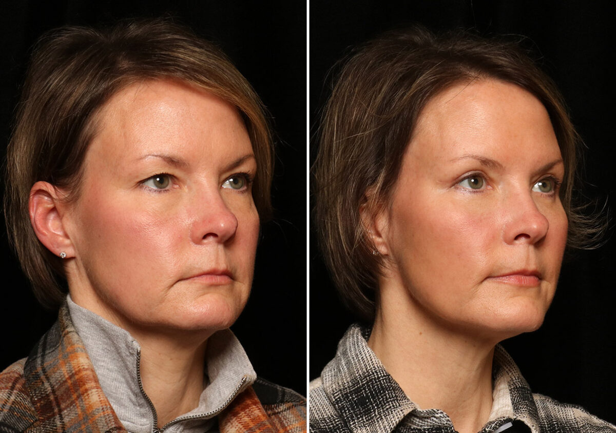 Blepharoplasty Fat Transfer Photos Cincinnati Oh Patient 12718