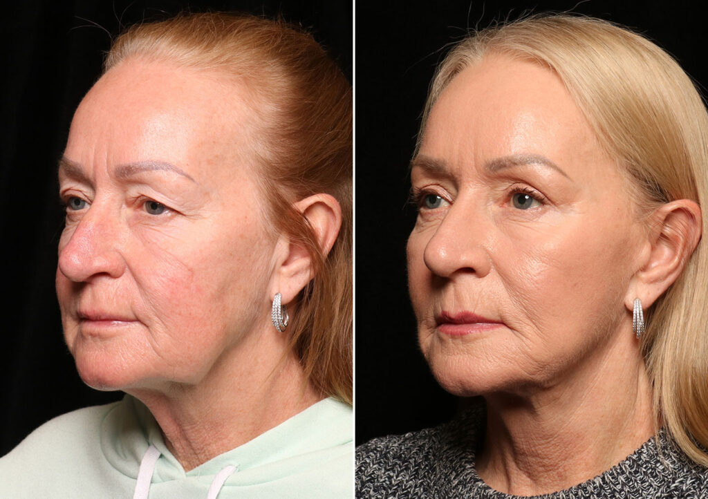 Before and After Photos - Donath Facial Plastic Surgery