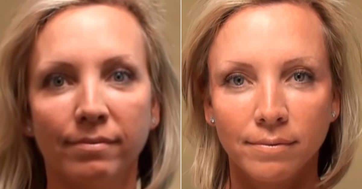 Botox in Cincinnati | Dysport | Donath Facial Plastic Surgery