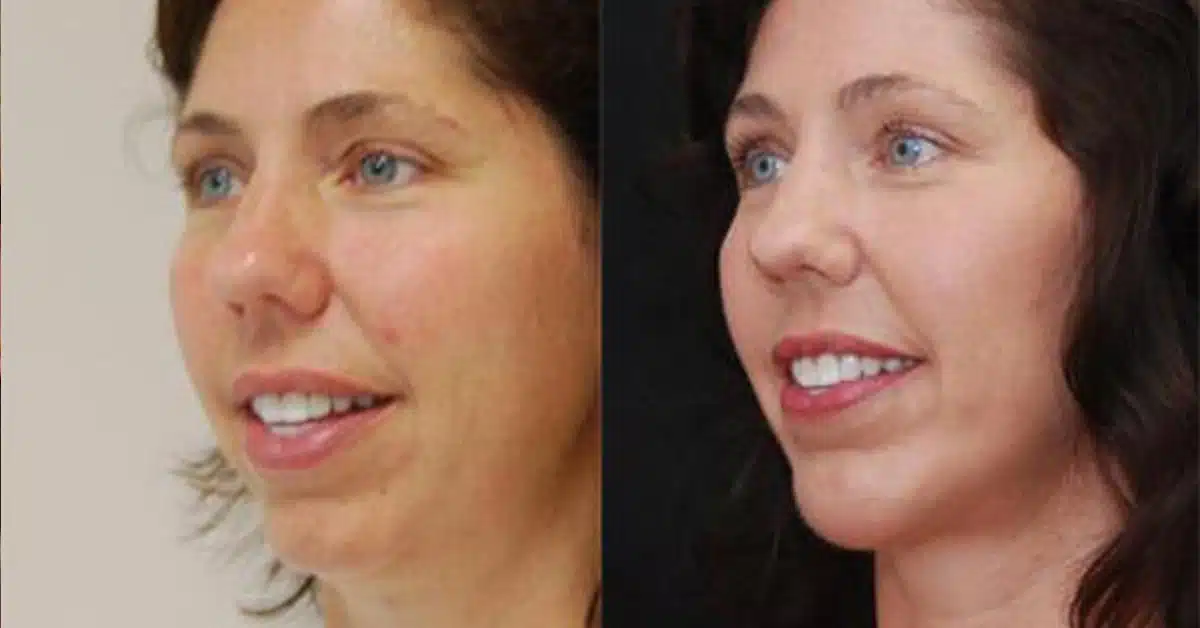 Chin Augmentation in Cincinnati | Dr. Alexander Donath