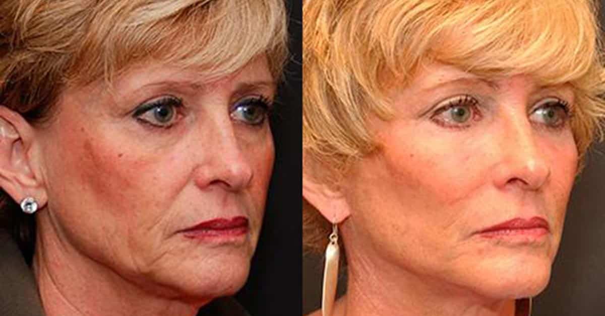 Laser Skin Resurfacing in Cincinnati | Dr. Alexander Donath