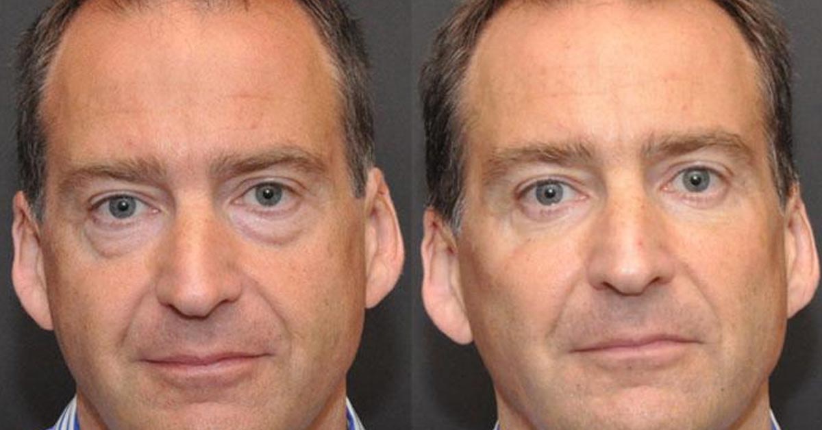 LuxeEyes in Cincinnati | Donath Facial Plastic Surgery