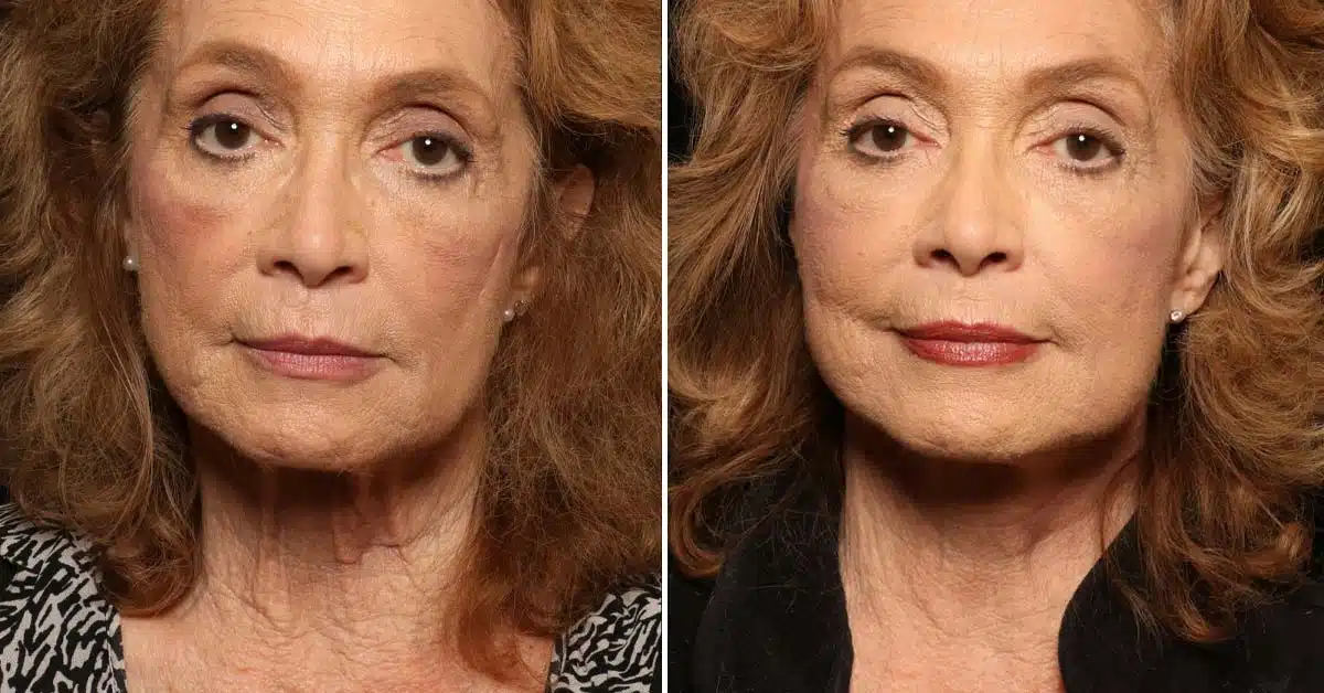 Mini Neck Lift in Cincinnati | Donath Facial Plastic Surgery